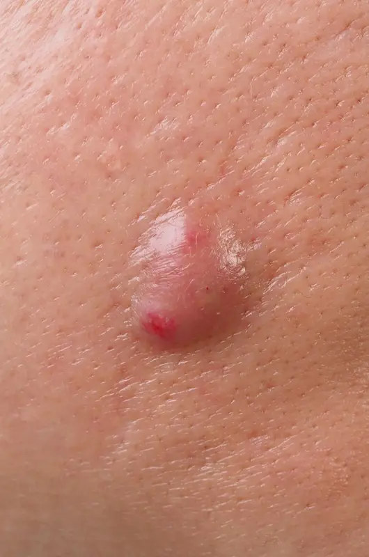 Cysts | Idaho Dermatology