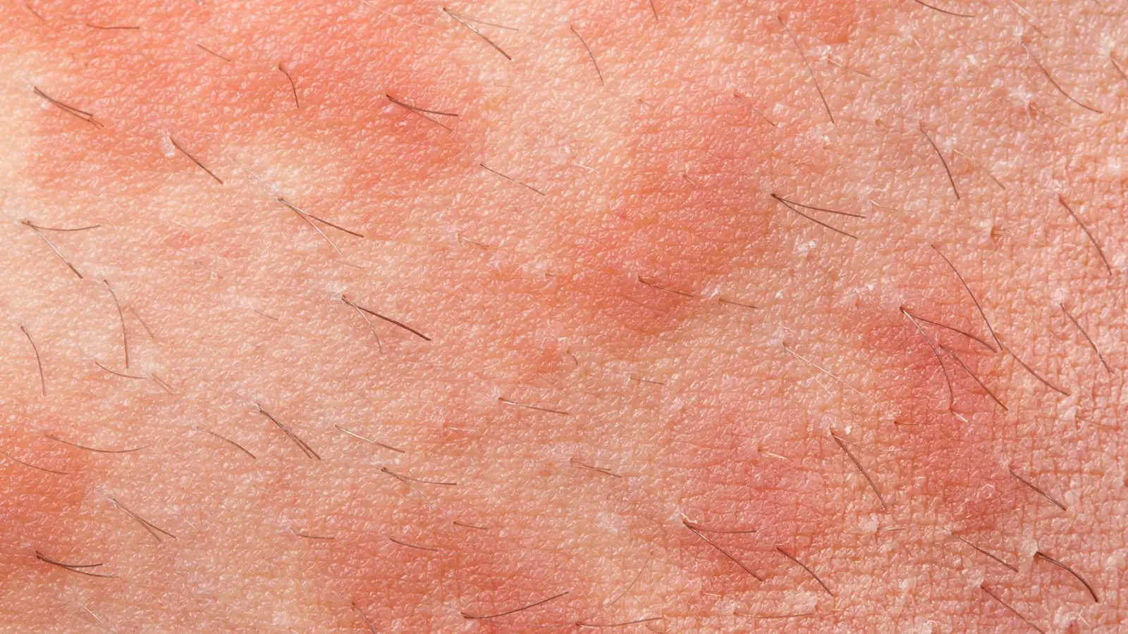 Rashes | Idaho Dermatology