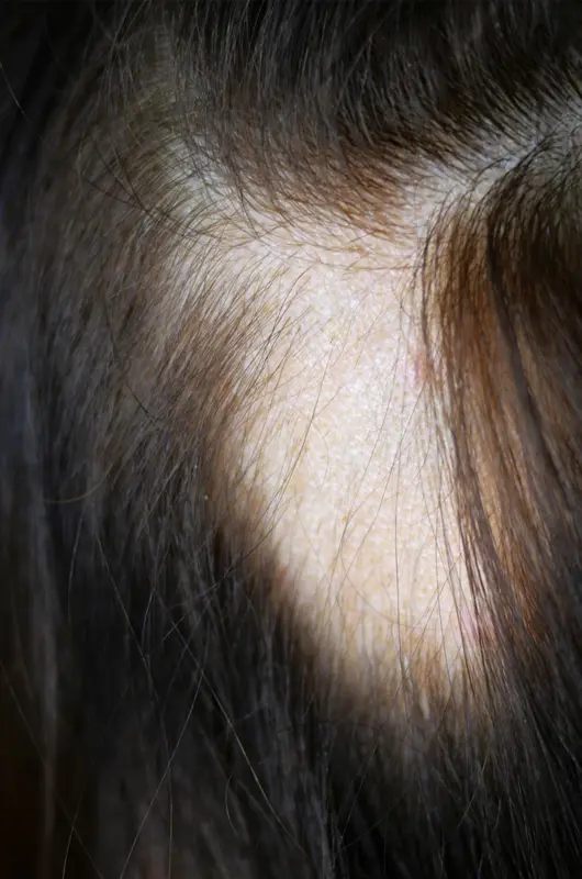 Hair Loss | Idaho Dermatology