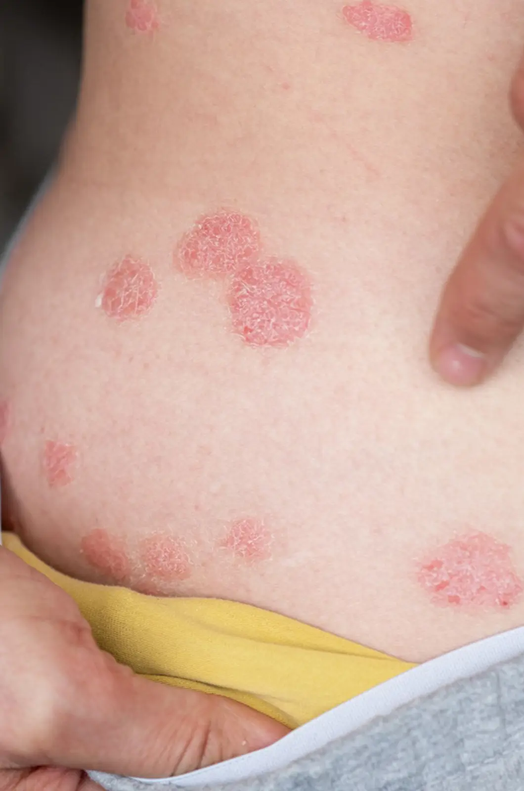 Psoriasis | Idaho Dermatology